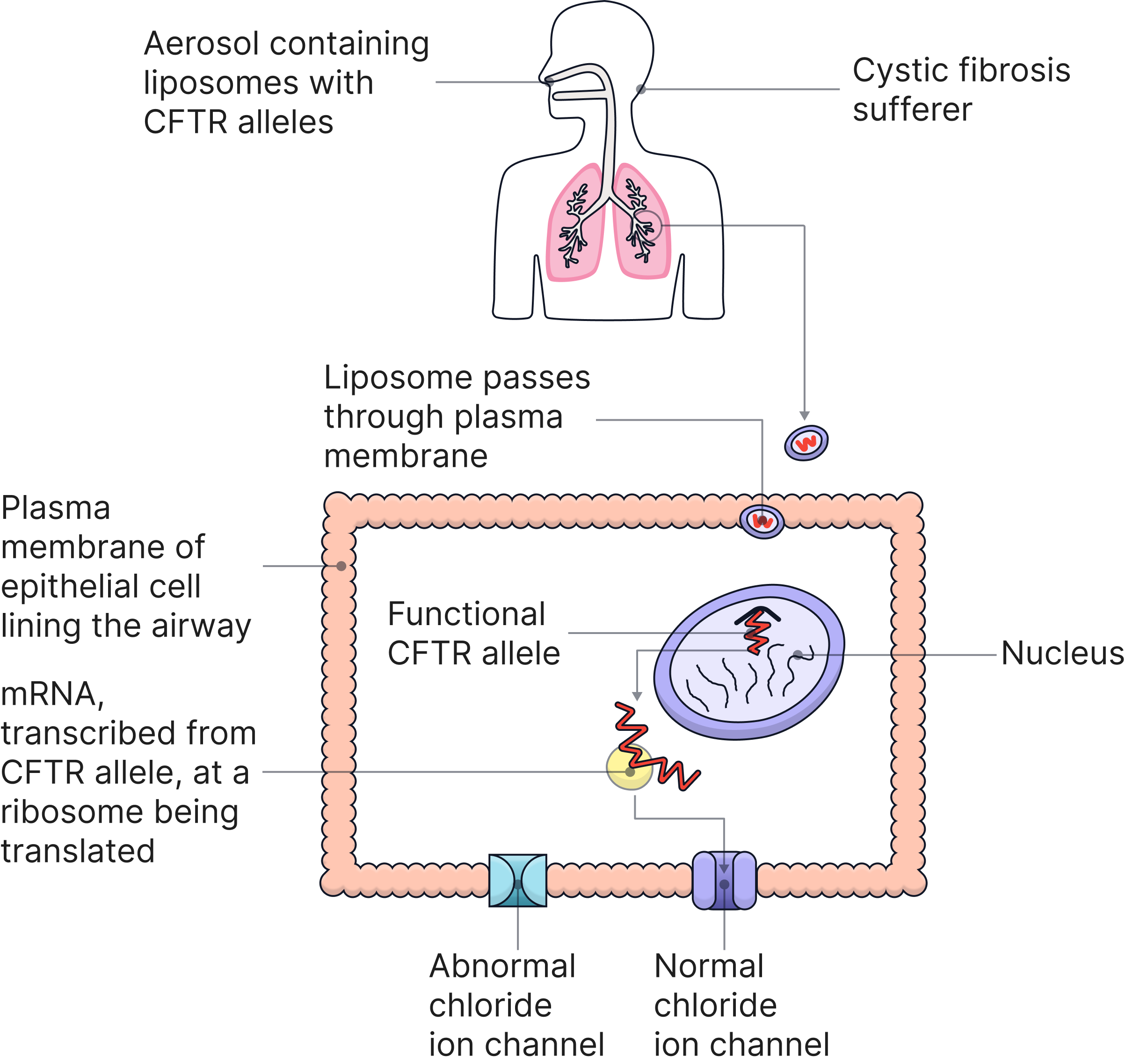 Gene Therapy AQA A Level Biology Gene Therapy AQA A Level Biology